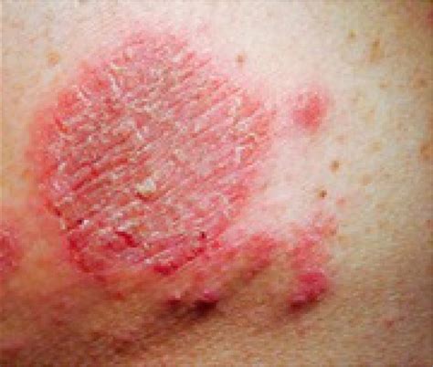 Seborrhoeic Dermatitis Legs