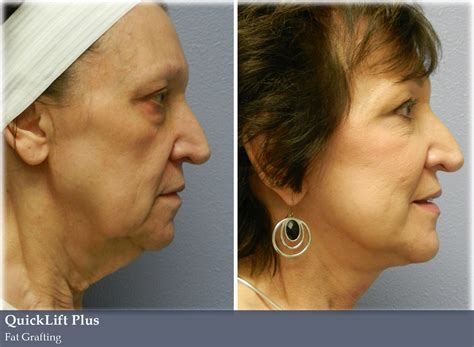 Quick Lift Vargas Face And Skin Center