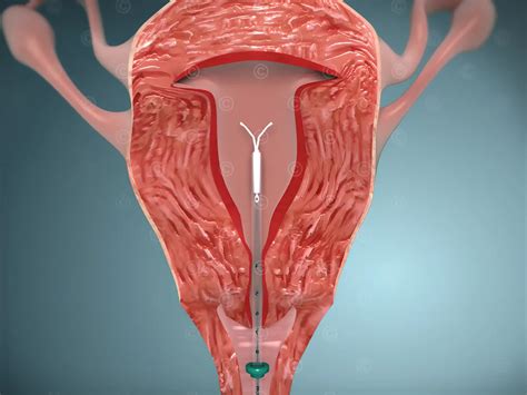 Uterus Anatomy Diagram With Iud Myometrium E Anatomy Imaios