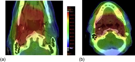 A Axial Computed Tomography Image Of Contralateral Parotid Sparing Download Scientific