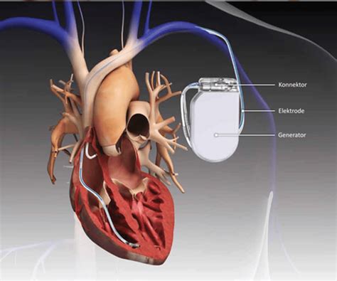 Who Needs A Pacemaker Understanding The Indications And Benefits Of Pacemaker Therapy Heart