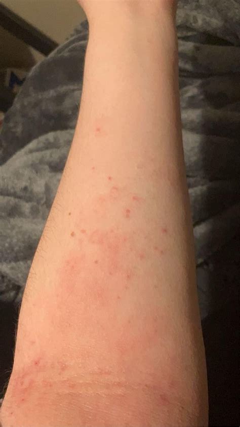 Does This Look Like It Could Be An Autoimmune Rash Rautoimmune