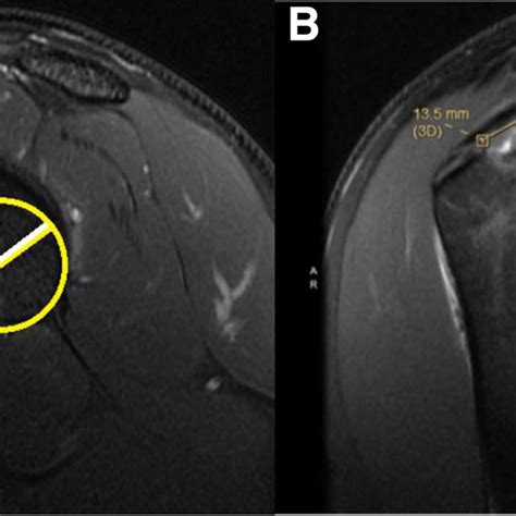 The Morphological Types Of The Glenoid Fossa And Their Incidence In The Download Scientific
