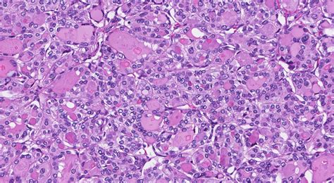 Your Pathology Report For Infiltrative Follicular Variant Papillary Thyroid Carcinoma