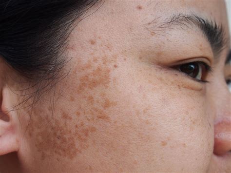 Removing Skin Pigmentation Tips And Advice