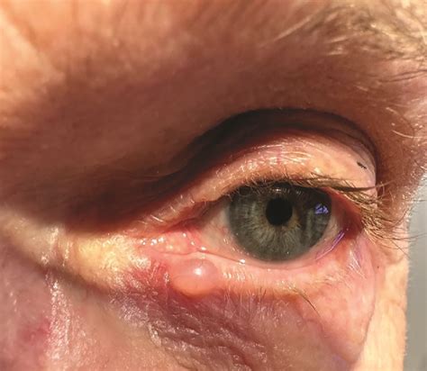 Eyelid Cyst Light Yellowish Cystic Nodule Near The Punctum In The