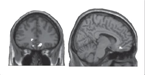 Differential Activation Of The Orbitofrontal Cortex OFC During Download Scientific Diagram