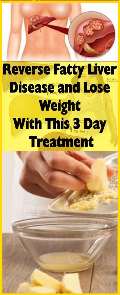Reverse Fatty Liver Disease And Lose Weight With This 3 Day Treatment