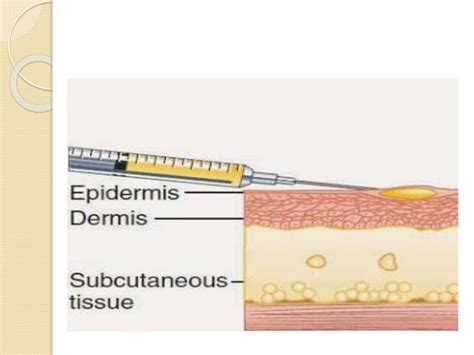 Intradermal Injection Introduction Procedure Complications Pptx