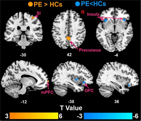 Voxel Wise Comparison Of Dc Value Between Lifelong Pe Patients And Hcs
