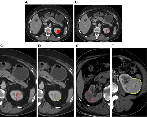 A Ct Based Tumoral And Mini Peritumoral Radiomics Approach Cmar