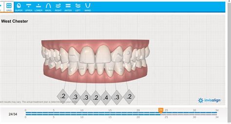 Got Access To My Clincheck Today And I Have A Question R Invisalign