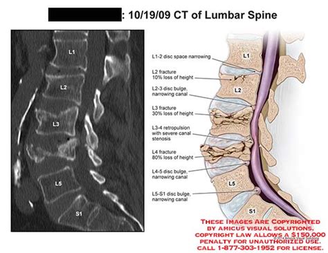 Amicus Illustration Of Amicusradiologyctlumbarspinel1l2l3l4l5
