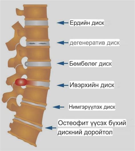 Маралгоо ⁉️Нурууны диск гэдэг нь нурууны яс үе хооронд байрлах зөөлөн