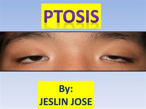 Ptosis Pptx