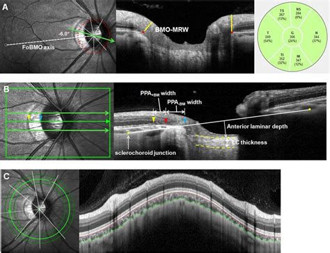 Methods Used For Onh Analysis By Using Sd Oct A Bruchs Membrane