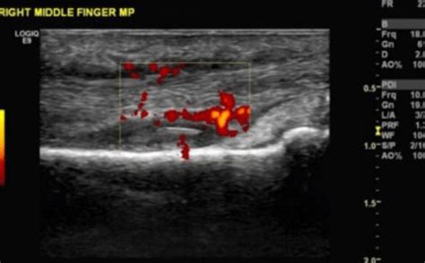 Finger Extensor Tendons Ultrasound