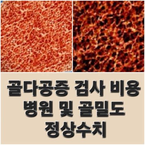 골다공증 검사 비용 병원 및 골밀도 정상수치 네이버 블로그