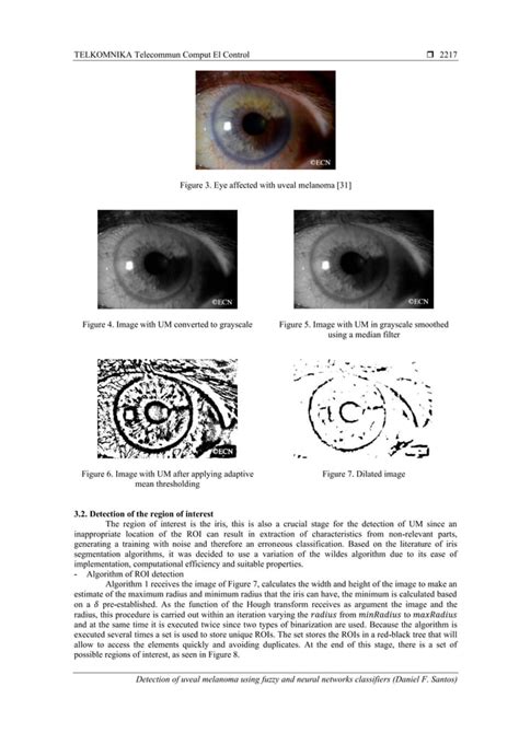 Detection Of Uveal Melanoma Using Fuzzy And Neural Networks Classifiers Pdf