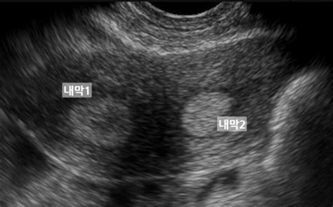 쌍각자궁 중격자궁 중복자궁 단각자궁 등 자궁기형은 임신가능 네이버 블로그