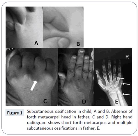 Pseudohypoparathyroidism Chart