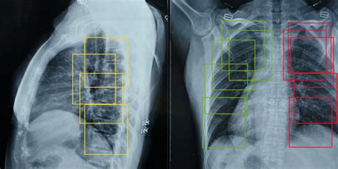 Ai Advances In Pneumonia Detection