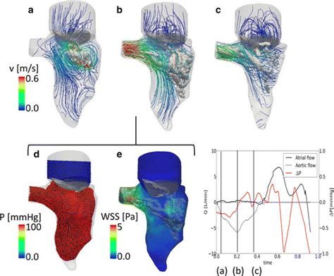 Systolic Flow Field Streamlines And Vortex Structure λ2 Ac