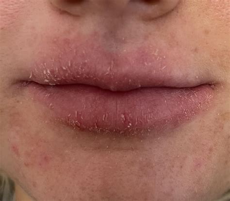 Help Rperioraldermatitis