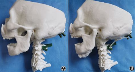 Simulated Surgery Based On The 3d‐printed Model A Simulated Screw