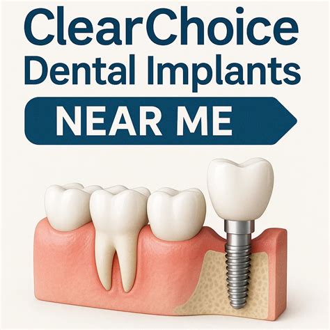 Clearchoice Dental Implants Near Me What They Are And How They Work