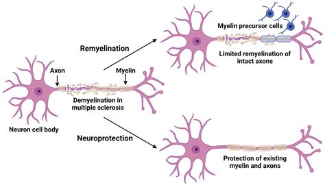 Remyelinating Versus Neuroprotective Therapies For Multiple Sclerosis