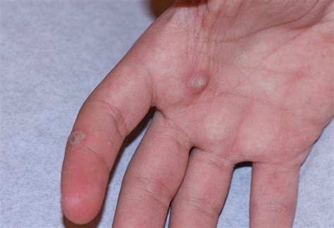 Flat Warts On Hands Removal