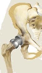 New Hip Replacement Alternative Christopher Cailes Fighting Arts