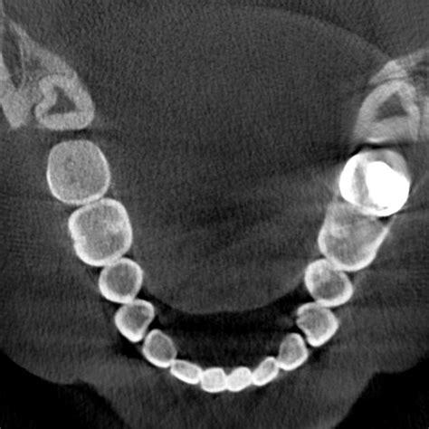 Pdf Artefacts In Cone Beam Ct