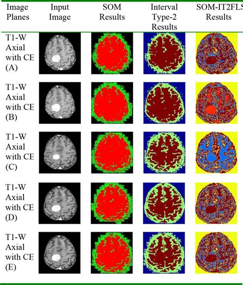 Segmentation Of Low‐grade Glioma In Brain Mr Slice Images Download Scientific Diagram