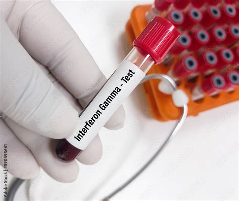 Scientist Holds Blood Sample For Interferon Gamma Test To Diagnosis Of