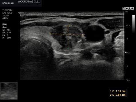 검진시 무증상 처음 시행한 갑상선 초음파 갑상선 결절 유두암 의증 갑상선 항진증 동반