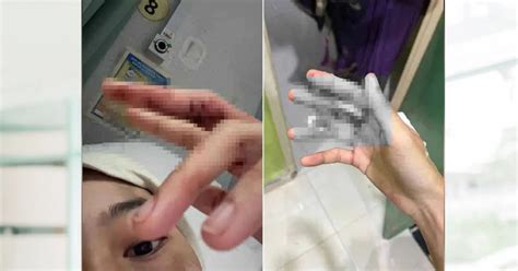 Digigit Ular Sawa Jari And Paha Gadis Cedera Ketika Buang Air Besar Di