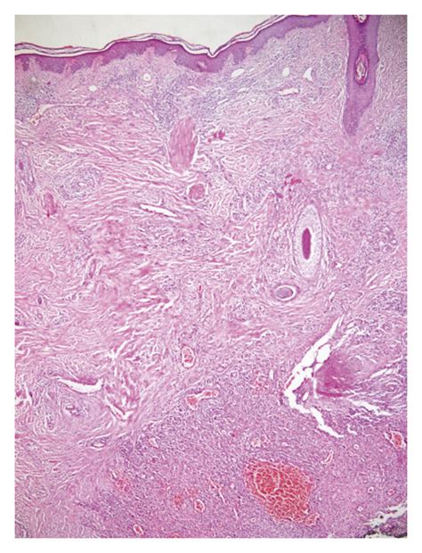 Dissecting Cellulitis Of The Scalp A Inflamed Granulation Tissue And Download Scientific