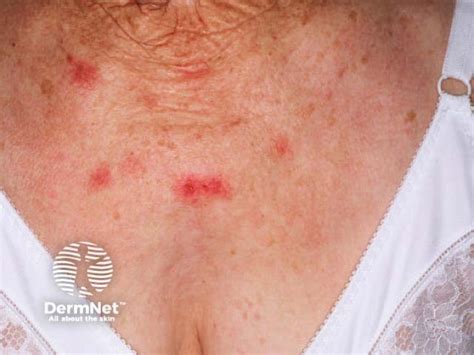 Insect Bite Images