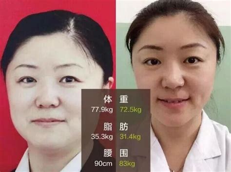 让肥胖不再烦恼，航空总医院开设医学减重专病门诊