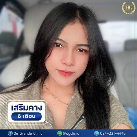 🎊 คางสวยทรงวีเชฟ ที่เดอแกรนด์คลินิก💞 👉 สำหรับโปรโมชั่นนี้‼️ ยังจองได้อยู่น้า 📱โปรโมชั่นดีๆแบบ