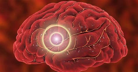 Terapia De Electrochoque Científicos Creen Haber Resuelto El Misterio