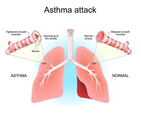 Asthma Attack Lungs Bronchi And Airways Bronchospasms Stock Vector