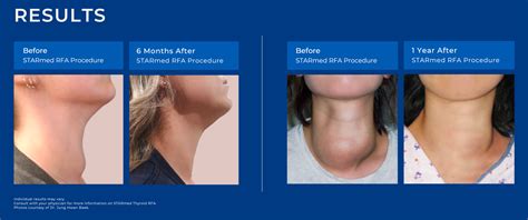 Rfa For Thyroid Nodules Portland Diabetes And Endocrinology Center