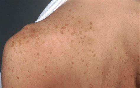 Brown Spots Hyperpigmentation Dermatology On Bloor