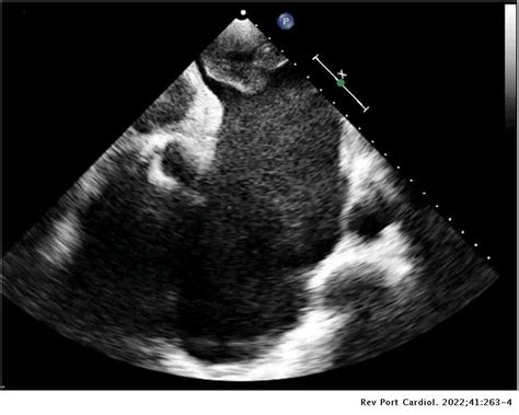 Left Atrial Appendage Thrombosis Discovered By Transthoracic