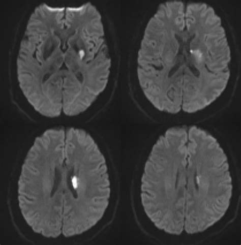 Anterior Choroidal Artery Supply Basal Ganglia Arteriovenous
