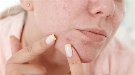Acne Vs Pimple Are They Actually The Same Thing Solawave