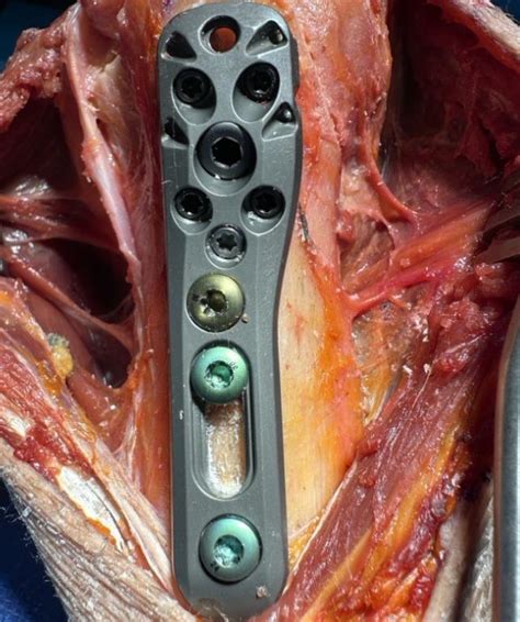 Proximal Humerus Fixation System Implants Orthobullets